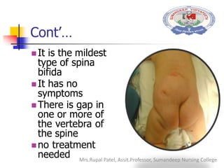 Spina bifida... | PPTX