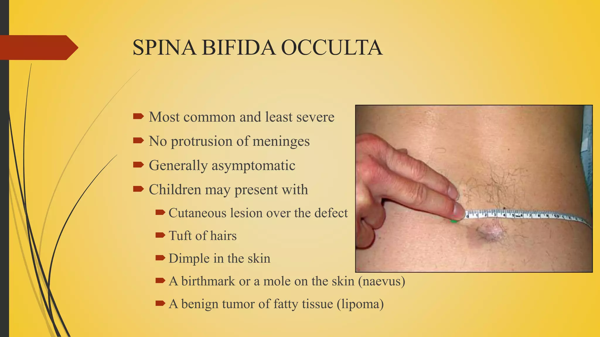 Spina bifida | PPTX
