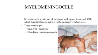 Spina bifida | PPTX