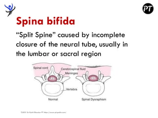 Spina Bifida - Dr Rohit Bhaskar | PDF