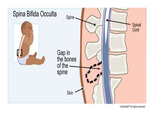Spina bifida | PPTX | Pregnancy | Reproductive Health