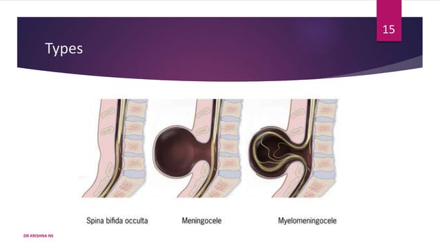 Spina bifida overview Clinical Neuro by Dr Krishna NS (M.O.Th-Neuro) | PPTX