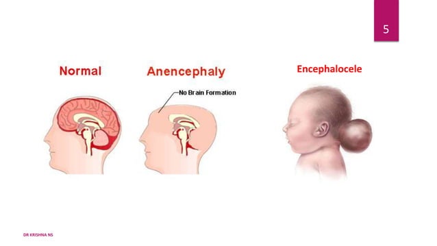 Spina bifida overview Clinical Neuro by Dr Krishna NS (M.O.Th-Neuro) | PPTX