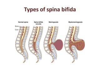 Spina bifida | PPTX
