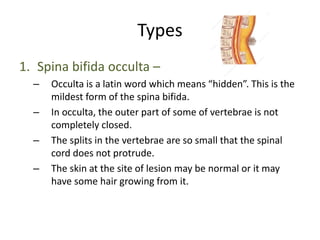 Spina bifida | PPT