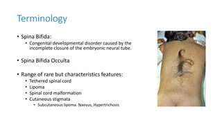 Spina Bifida.pptx | Pregnancy | Reproductive Health