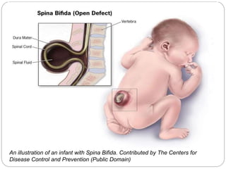 Spina Bifida.pptx