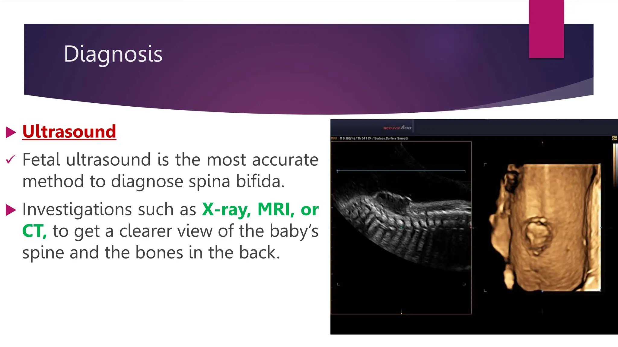 spina bifida (neural tube defects) .pptx