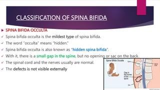 spina bifida (neural tube defects) .pptx