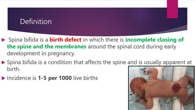 spina bifida (neural tube defects) .pptx