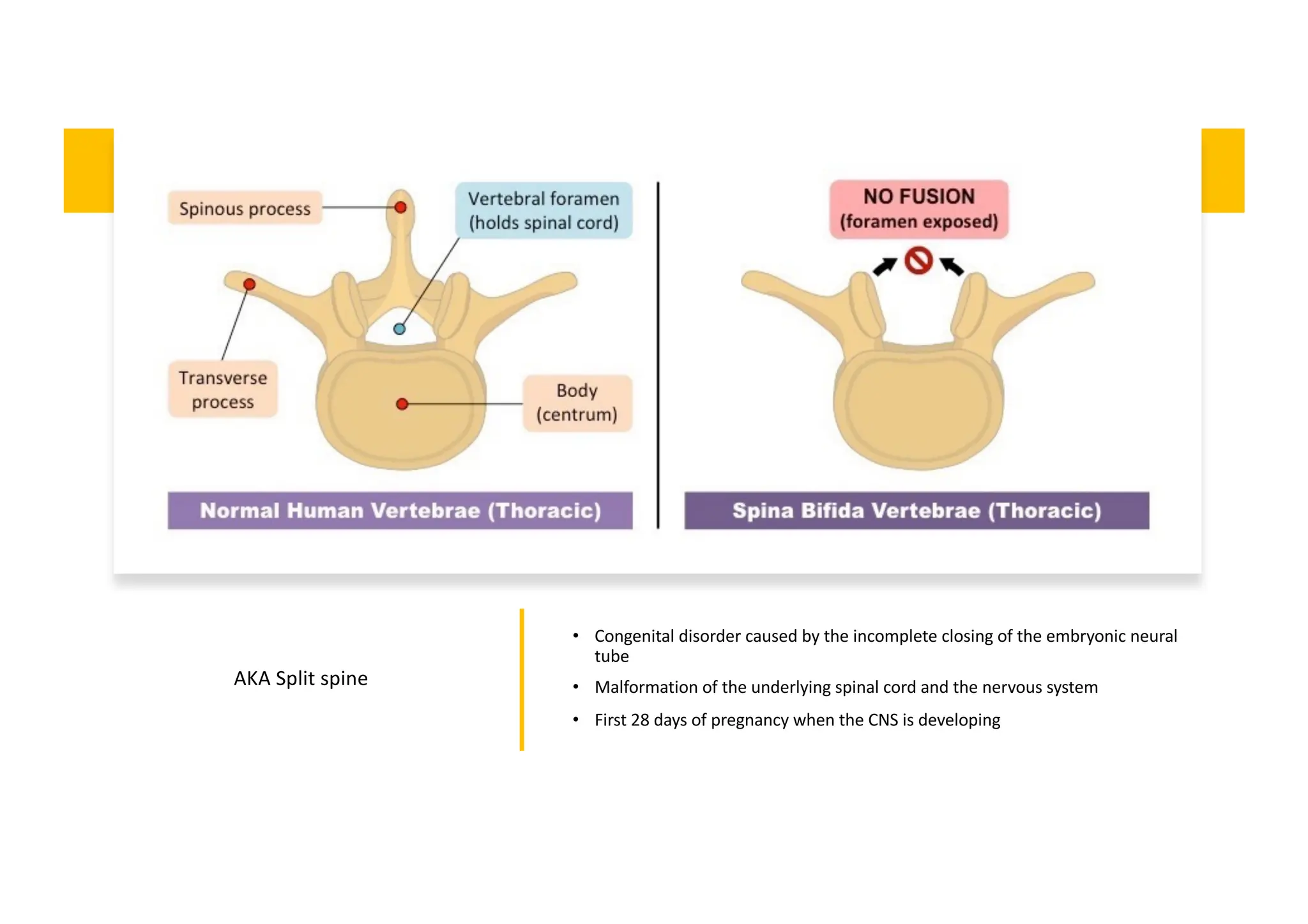 Spina Bifida physiotherapy for pediatrics.pdf