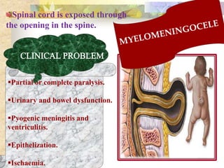 spina bifida in newborn disorders of high risk in pregnancy | PPT