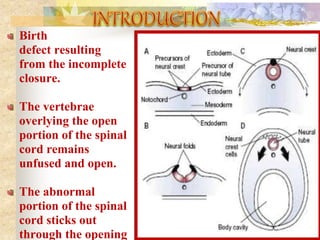 spina bifida in newborn disorders of high risk in pregnancy | PPT