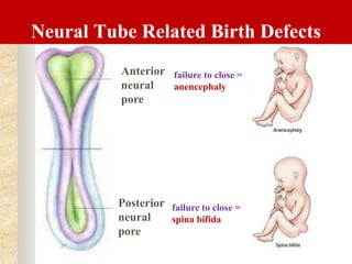 spina bifida in newborn disorders of high risk in pregnancy | PPT