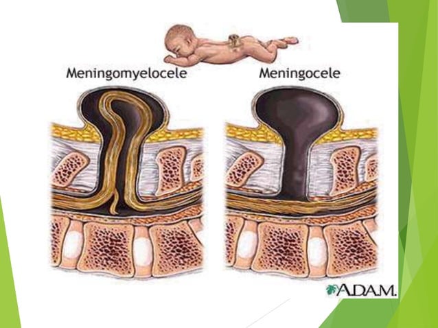 spina bifida types classifications and detailed patho | PPT