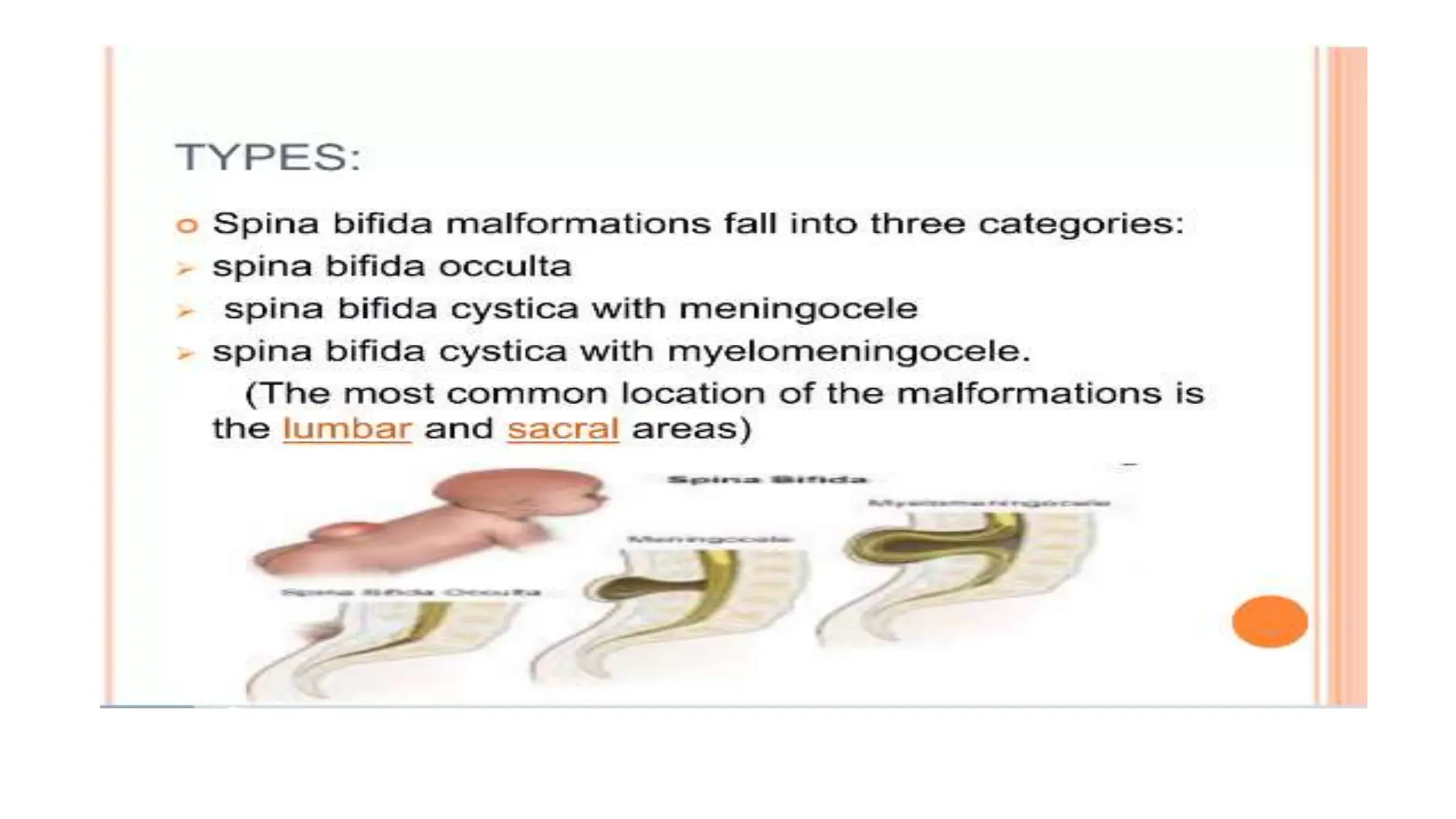 Spina Bifida assessment and management .ppt