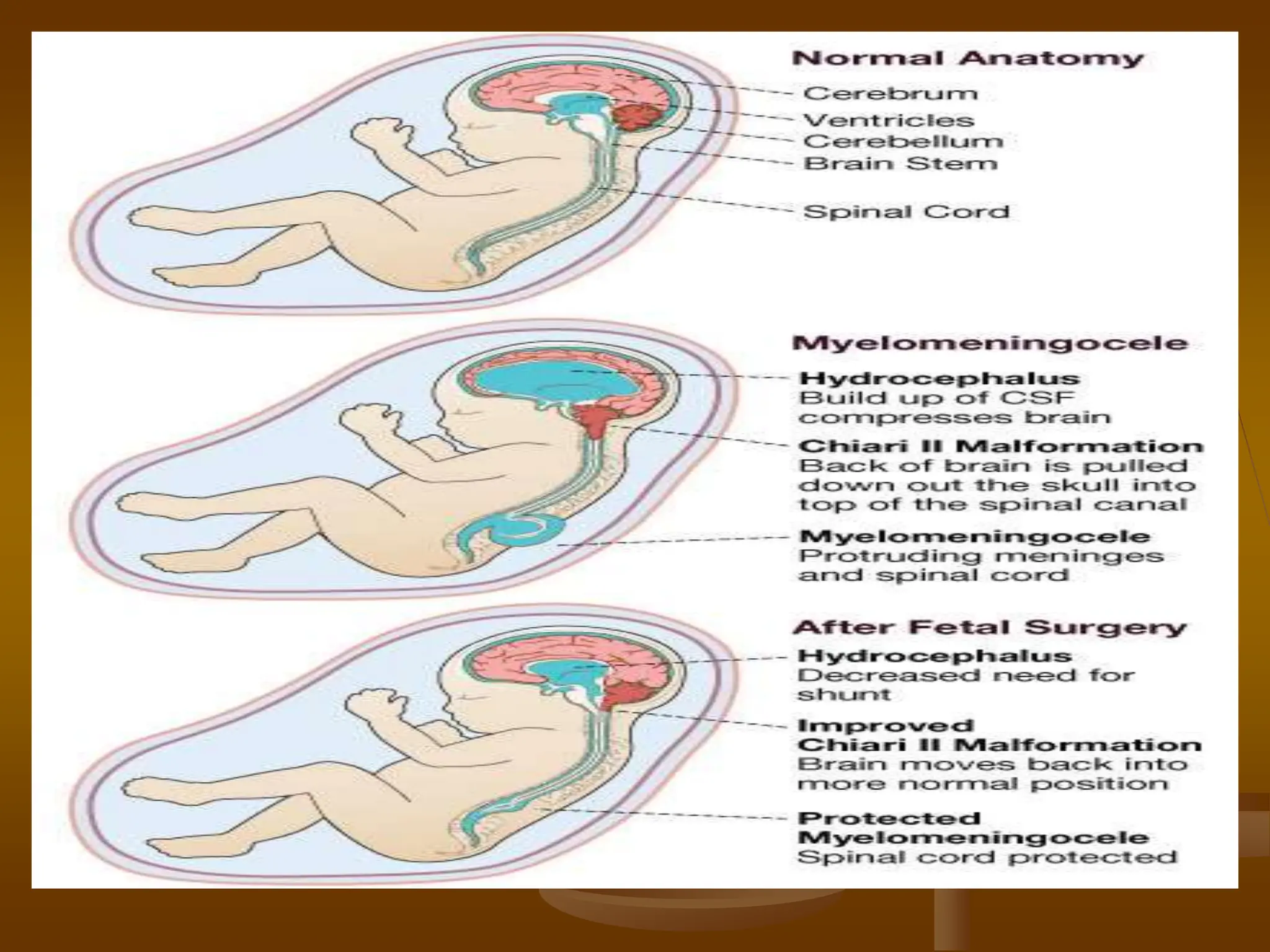 Spina Bifida Birth defect spinal nerves spinal cord | PPTX