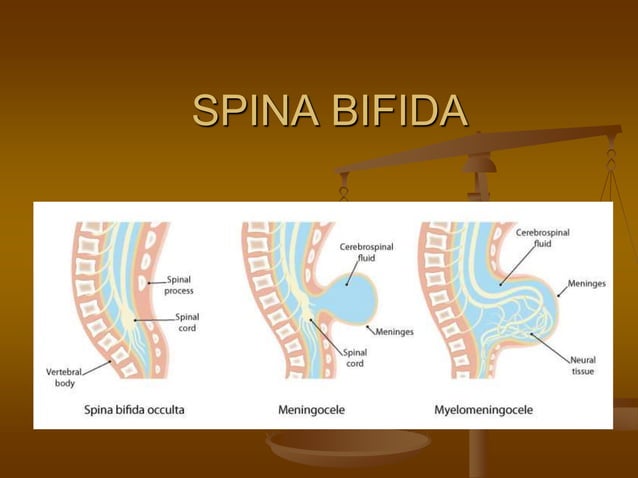 Spina Bifida Birth defect spinal nerves spinal cord | PPTX