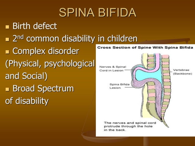 Spina Bifida Birth defect spinal nerves spinal cord | PPTX