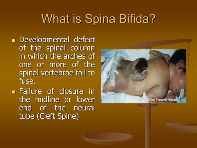Spina Bifida Birth defect spinal nerves spinal cord | PPTX