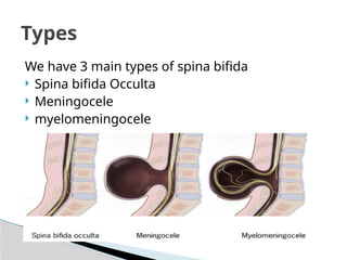 SPINA BIFIDA.pptx one of the neural tube defects | PPTX