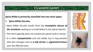 SPINA BIFIDA: NURSING MANAGEMENT .pptx
