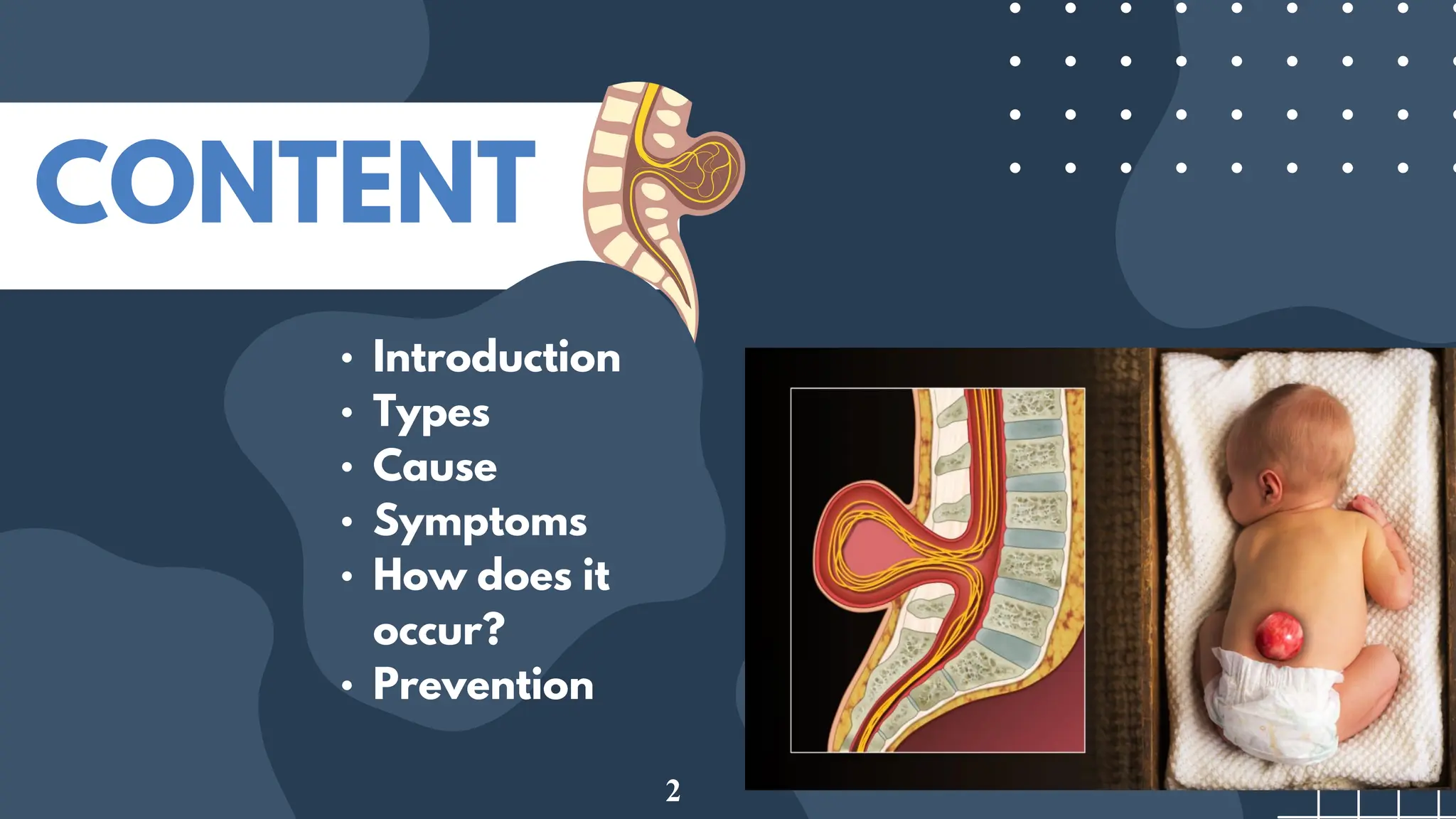Spina bifida is when a baby's spine and spinal cord does not develop ...