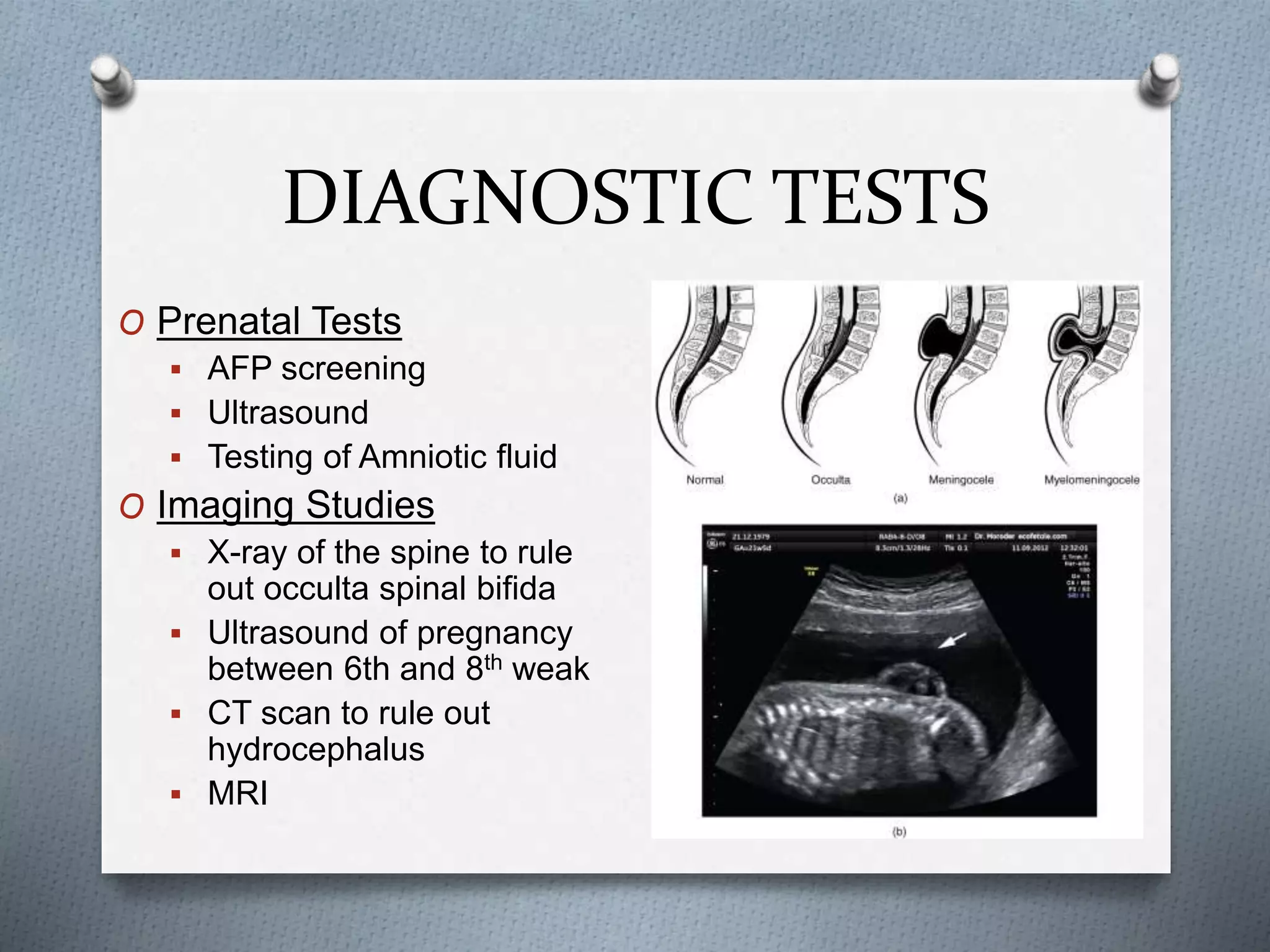 Spina bifida - Child Health Nursing | PPTX