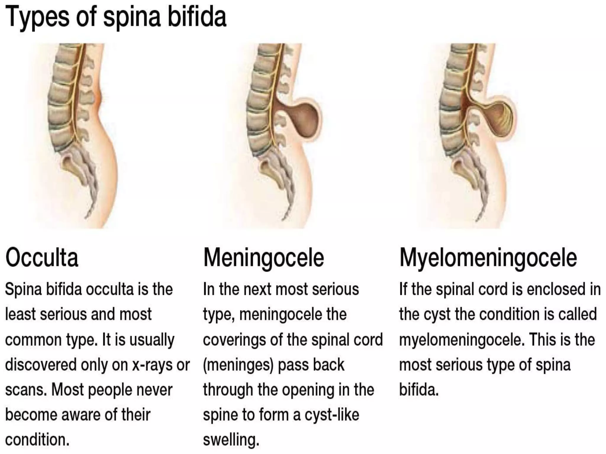 Spina bifida - Child Health Nursing | PPTX