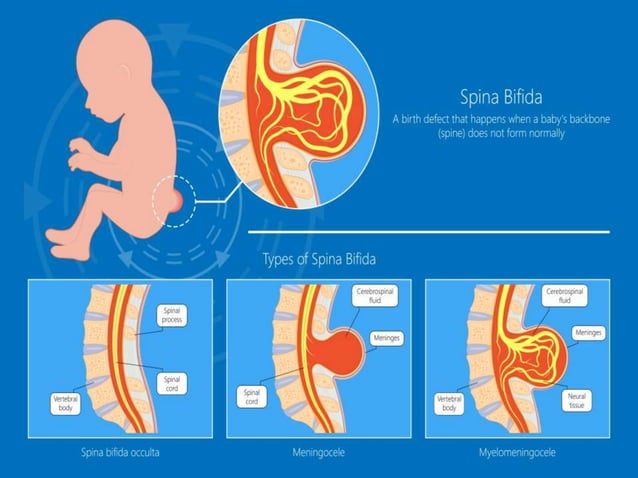 Spina bifida - Child Health Nursing | PPTX