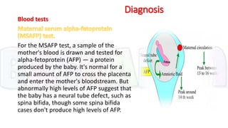 Spina Bifida (2).pptx2222222222222222222 | PPT