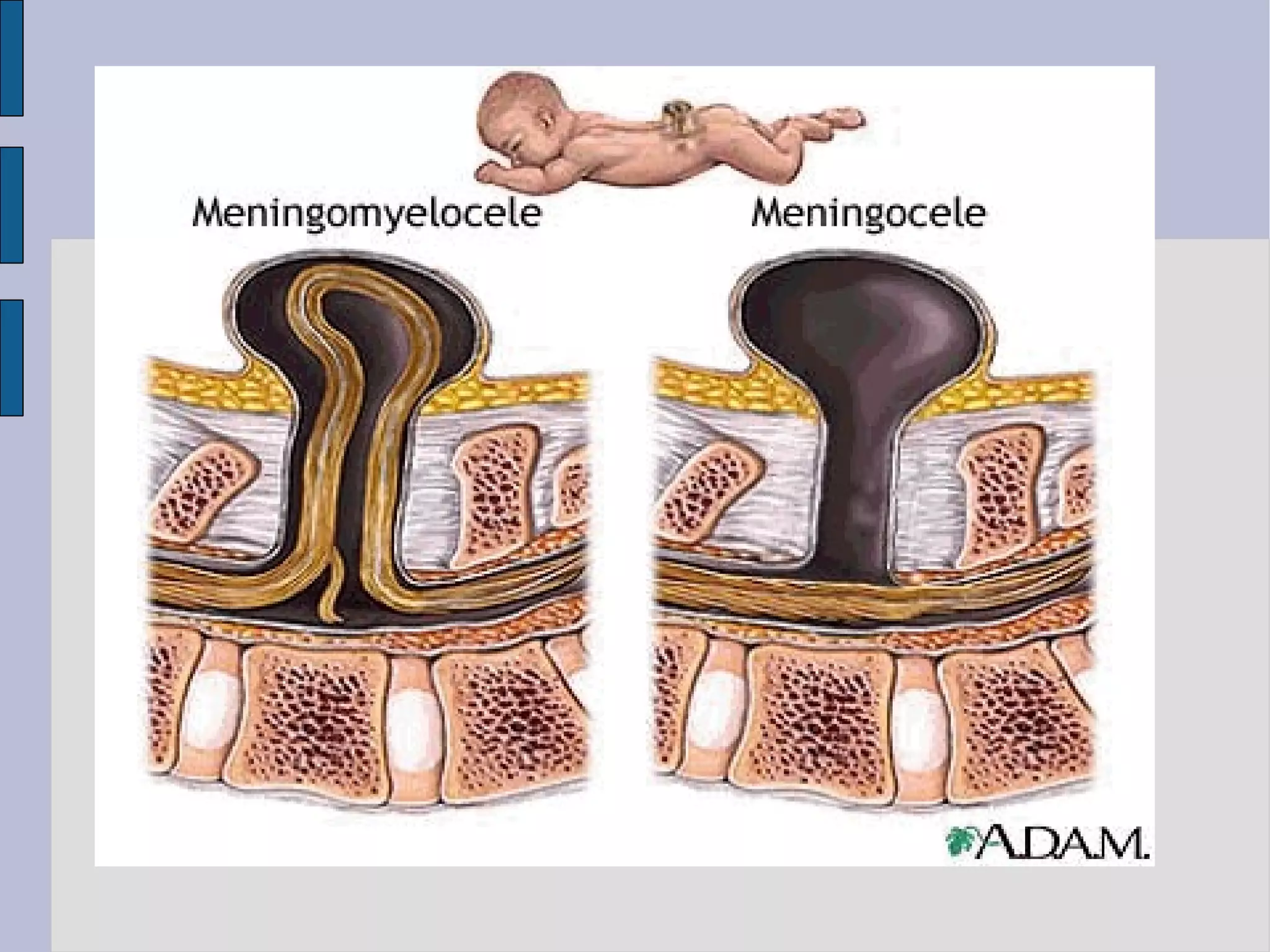 Spina Bifida And Open Neural Tube Defects | PPT