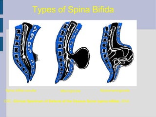 Spina Bifida And Open Neural Tube Defects | PPT