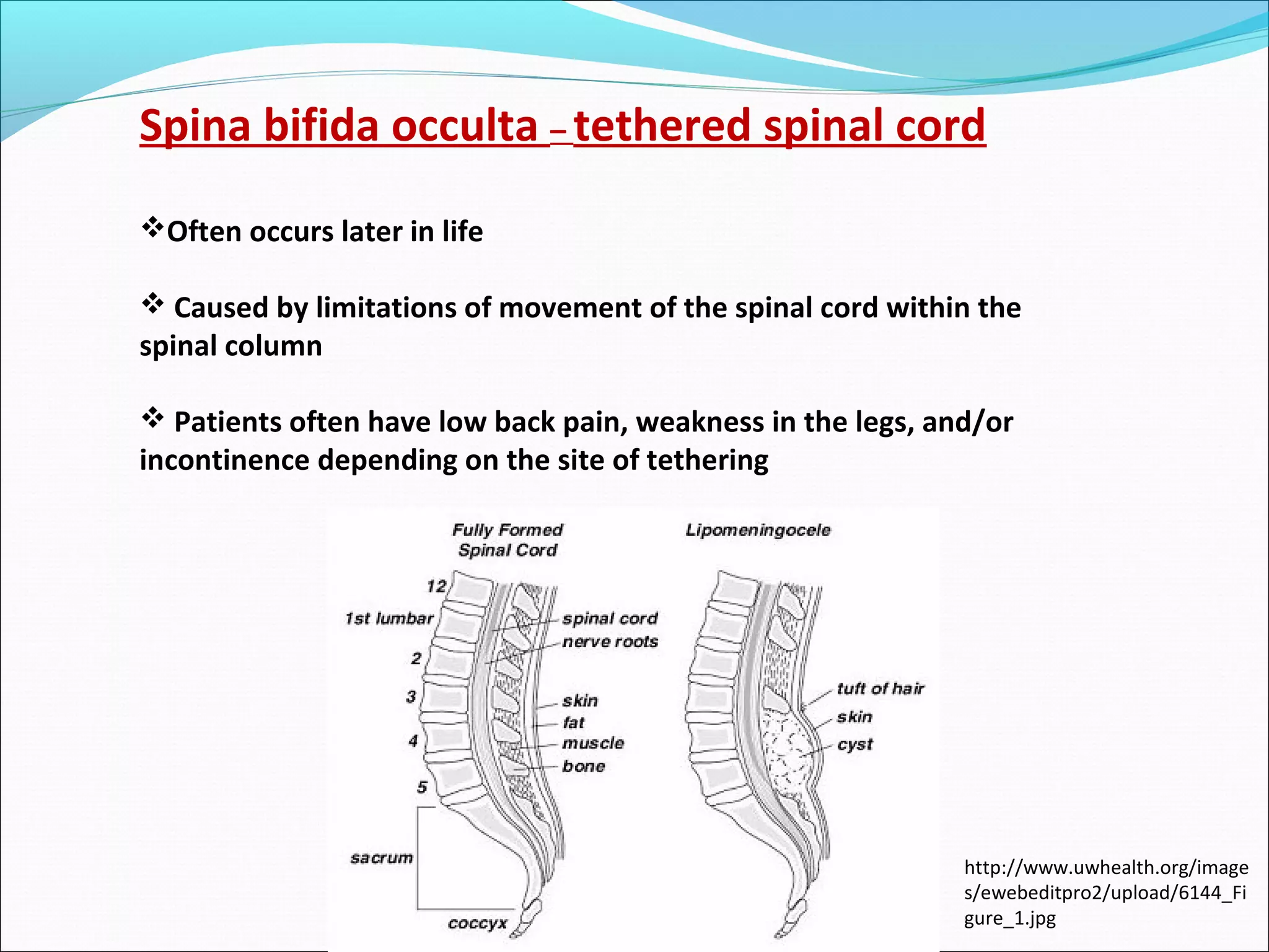 Spina bifida and physiotherapy | PPT