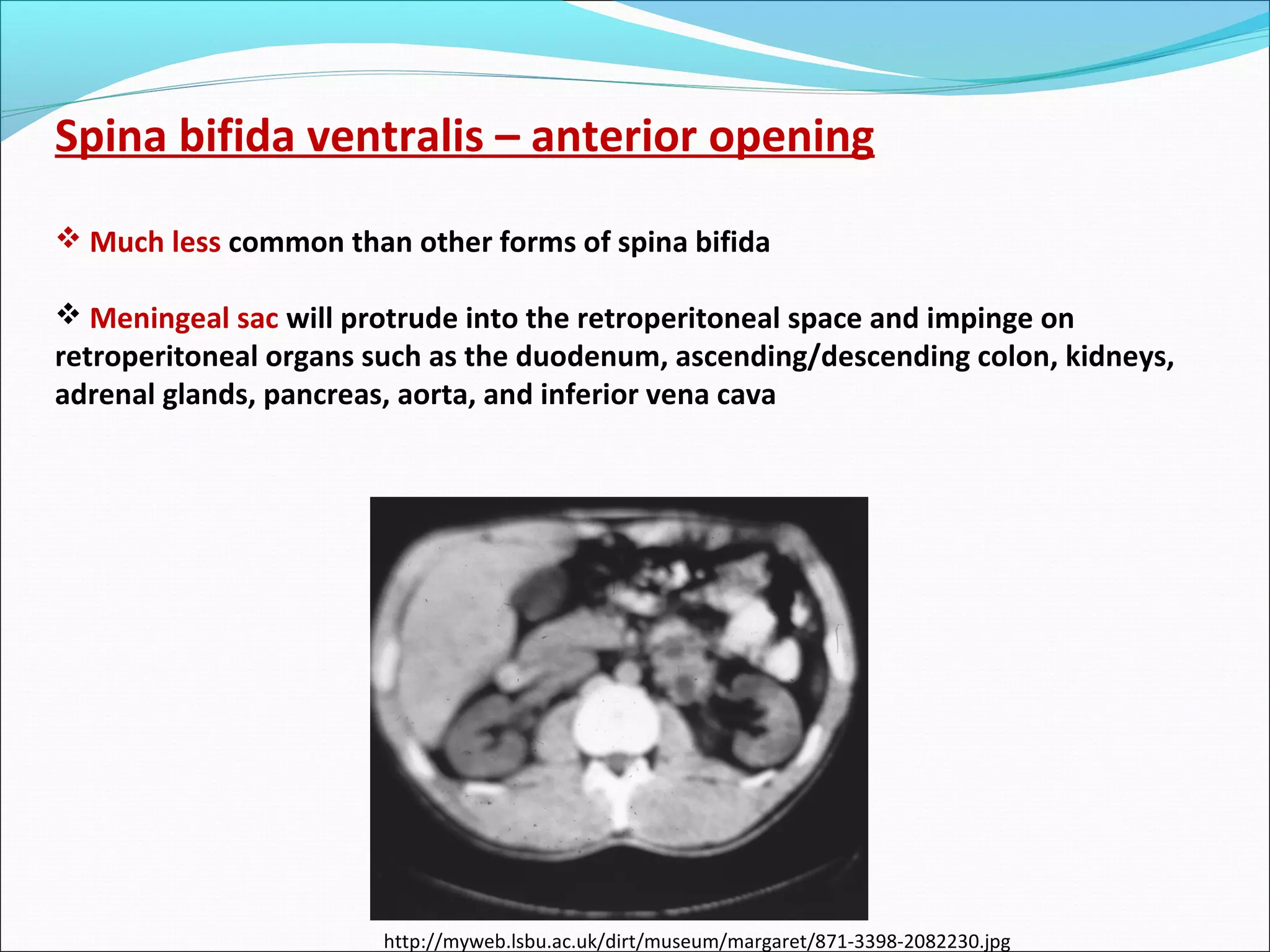 Spina bifida and physiotherapy | PPT