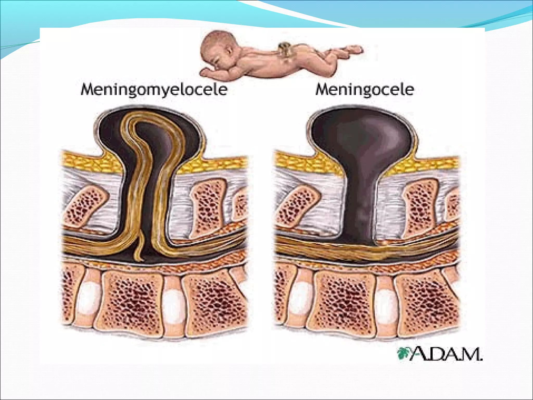 Spina bifida and physiotherapy | PPT