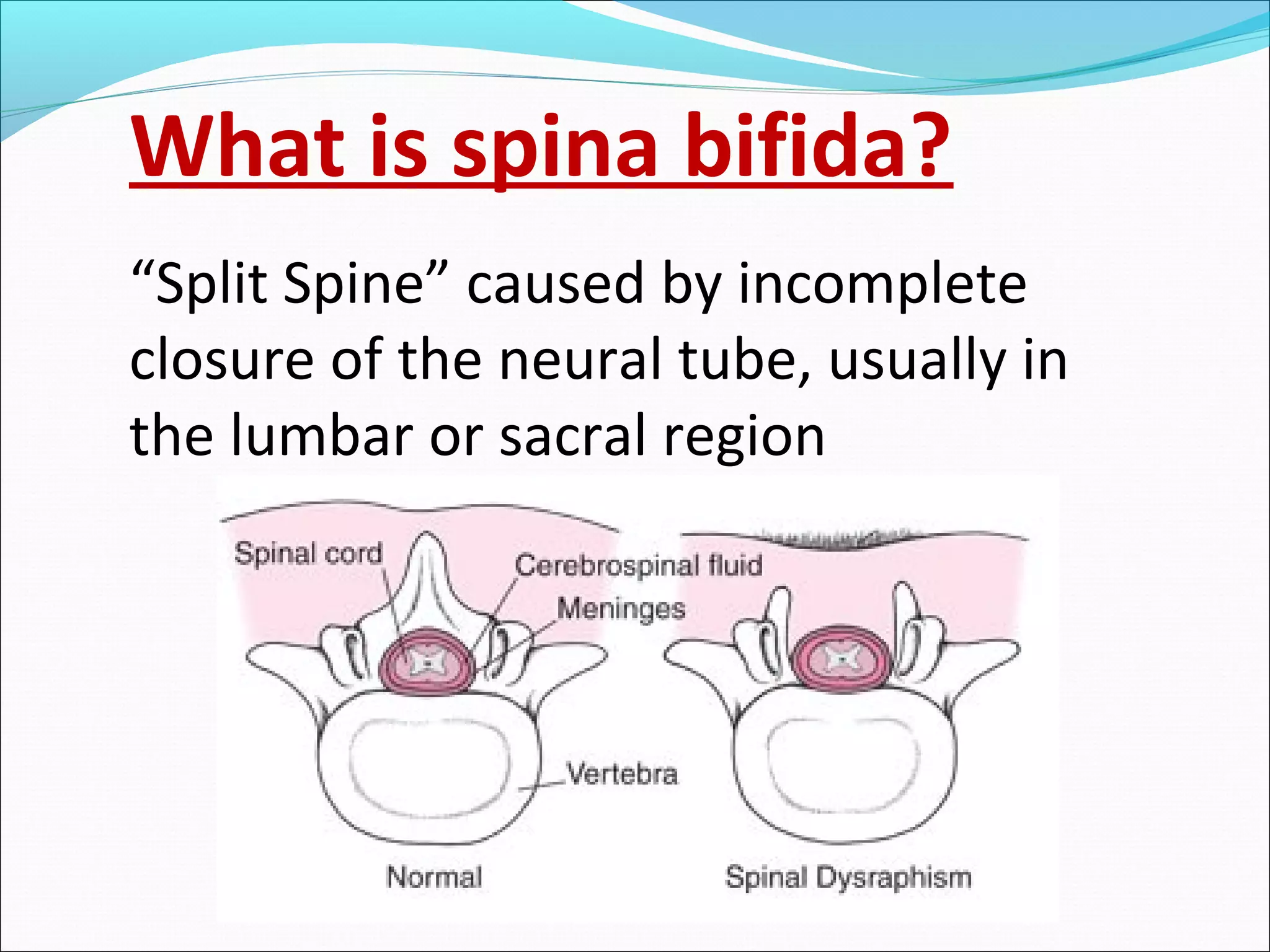 Spina bifida and physiotherapy | PPT