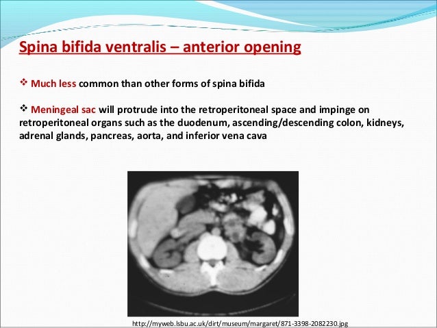 Spina bifida and physiotherapy