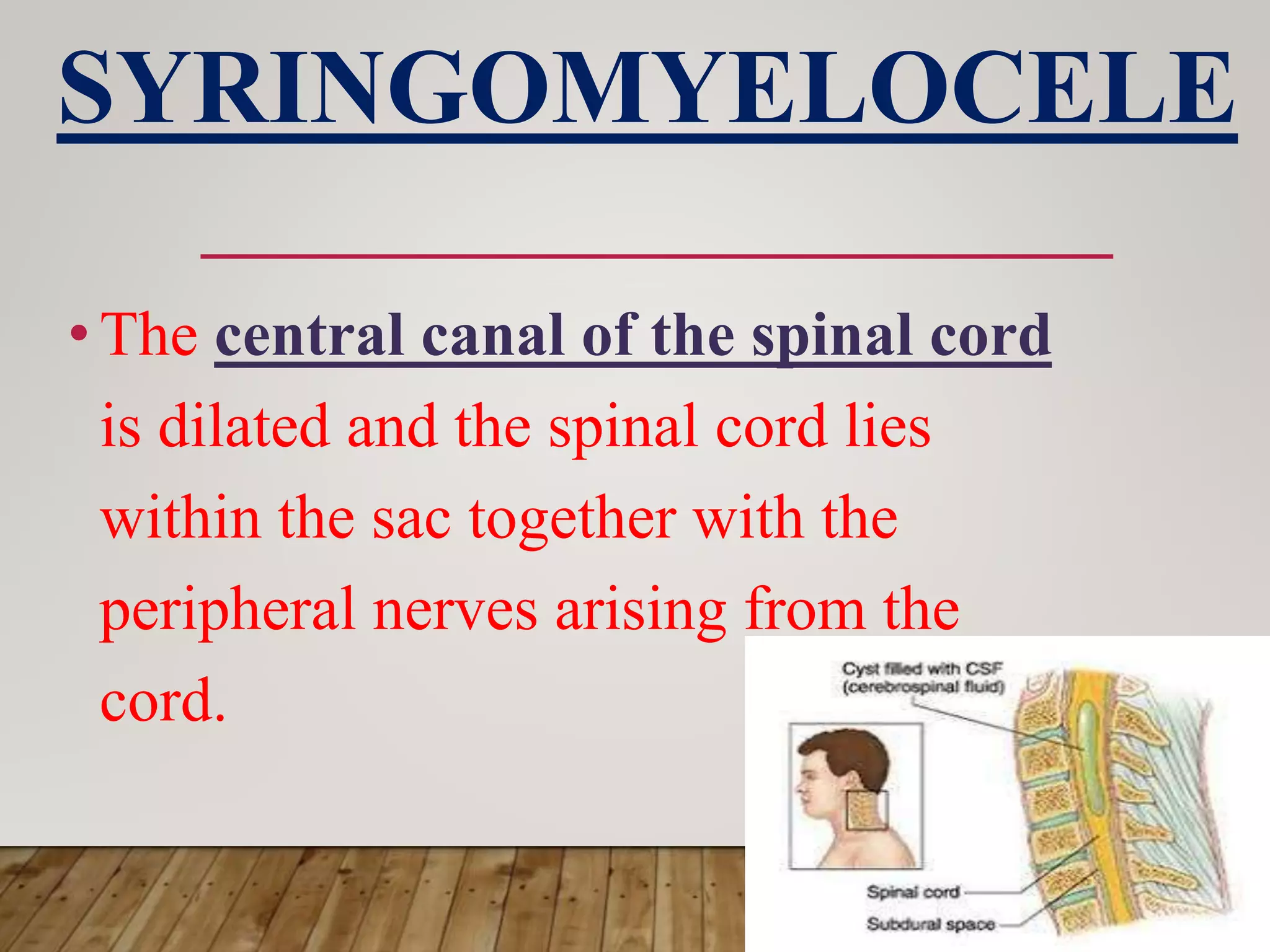 spina bifida and pt mangement [Autosaved].pptx