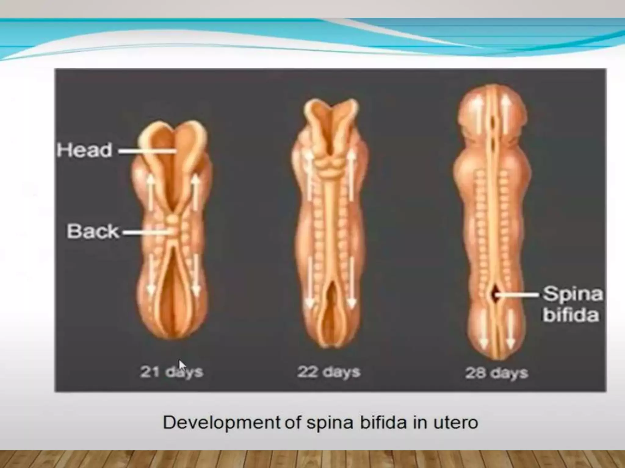 spina bifida and pt mangement [Autosaved].pptx