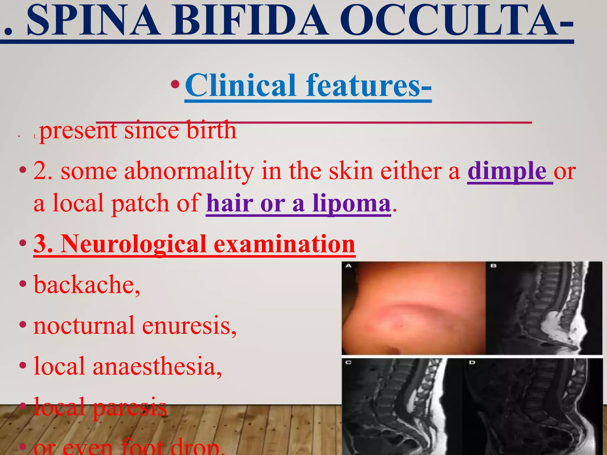 spina bifida and pt mangement [Autosaved].pptx