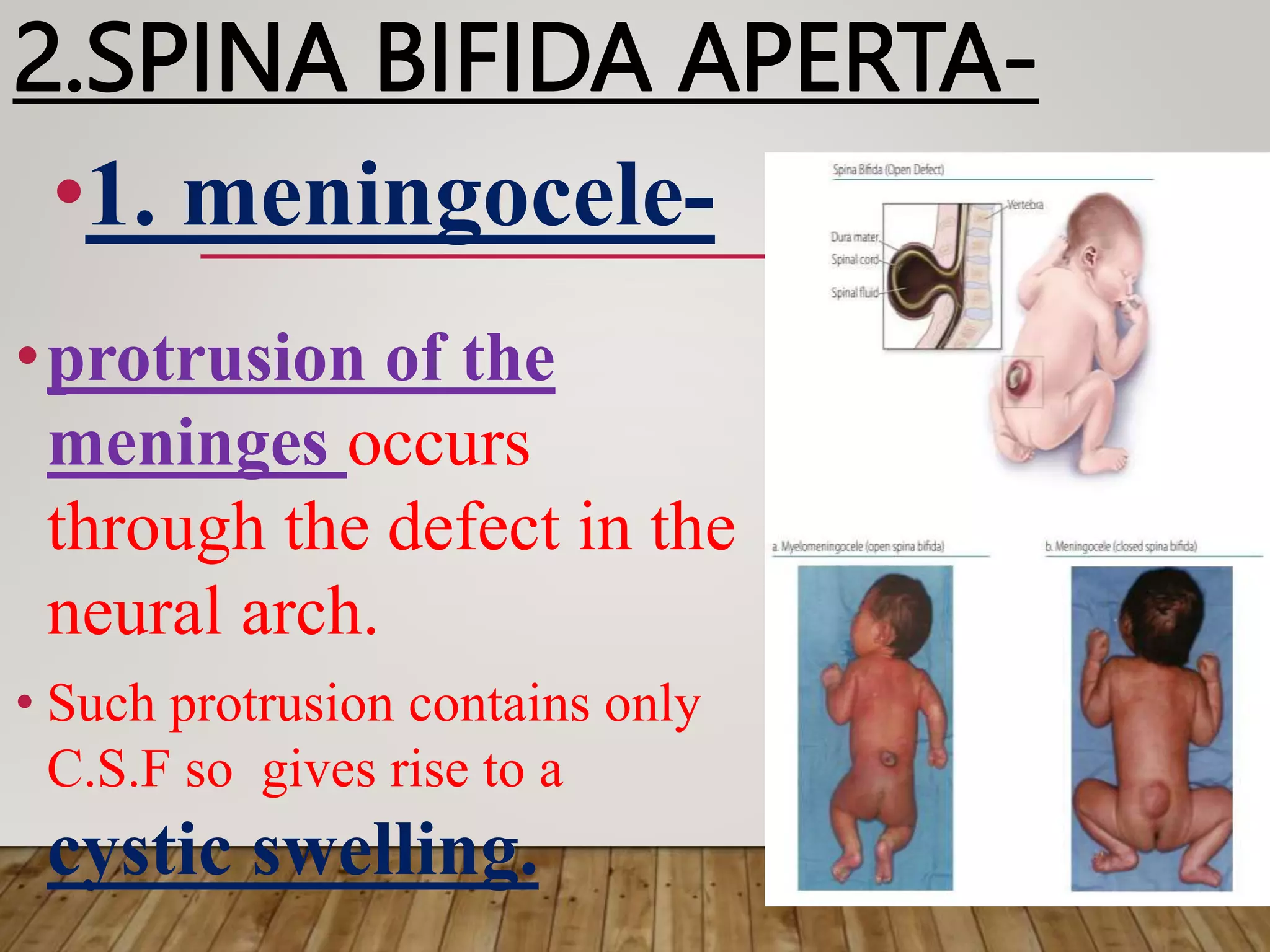 spina bifida and pt mangement [Autosaved].pptx