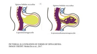 Physiotherapy management of spina bifida ppt by Oluwadamilare Akinwande ...