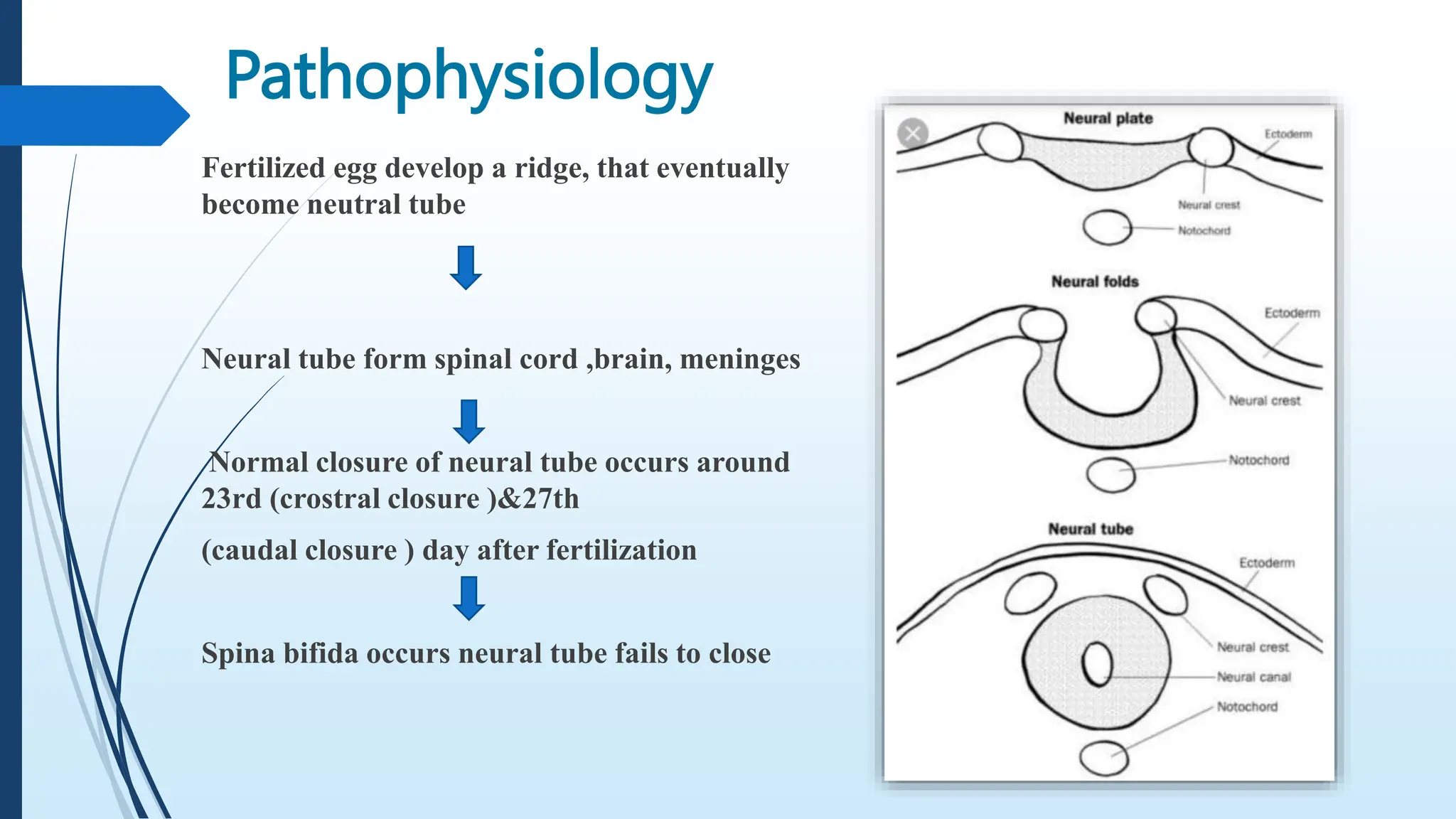 SPINA BIFIDA n-1.pptx Presentation on Spina bifida | PPTX