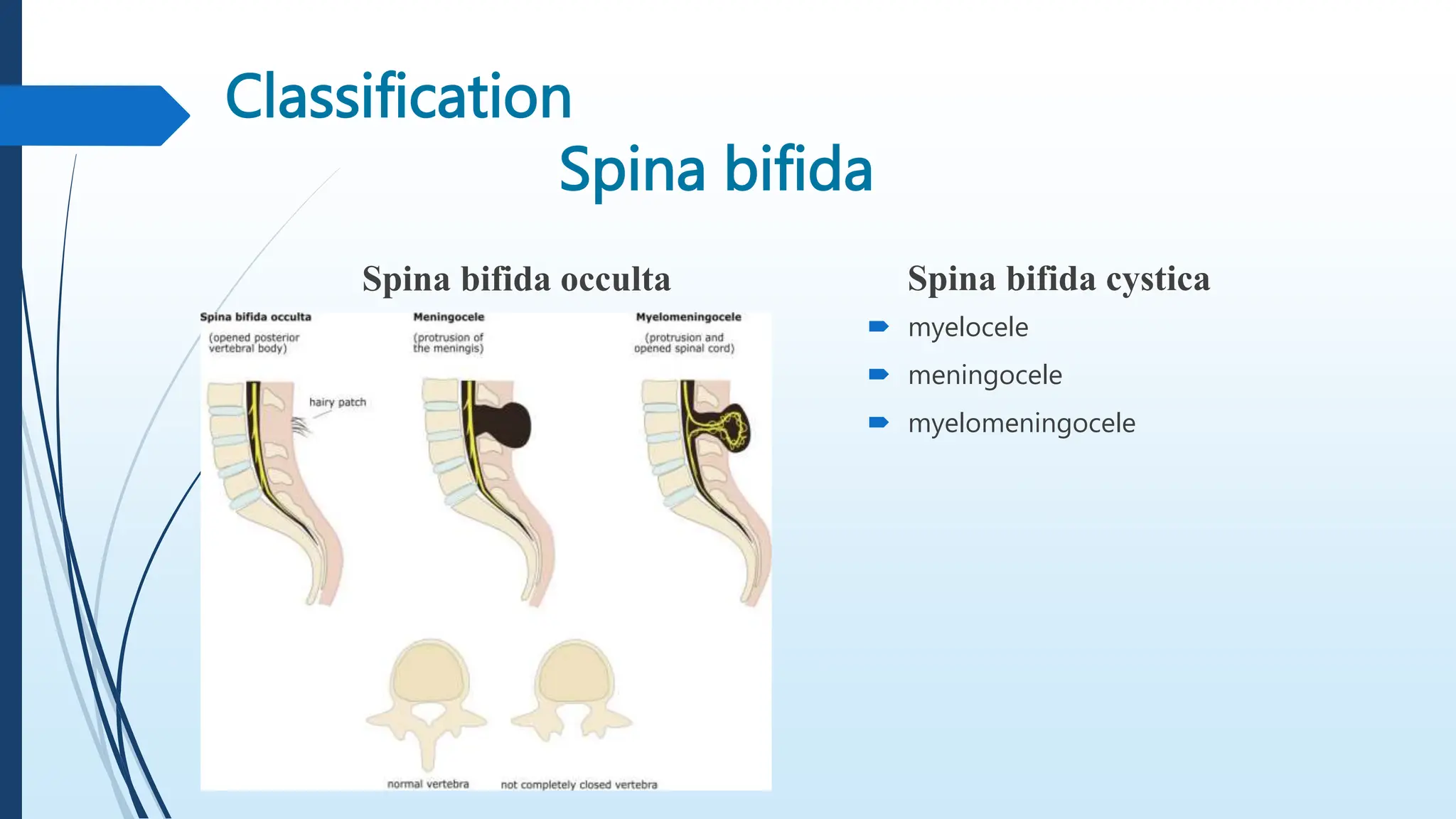 SPINA BIFIDA n-1.pptx Presentation on Spina bifida | PPTX