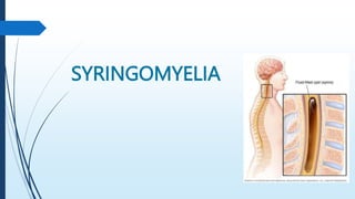 SPINA BIFIDA n-1.pptx Presentation on Spina bifida | PPTX