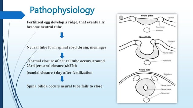 SPINA BIFIDA n-1.pptx Presentation on Spina bifida | PPTX | Brain and ...
