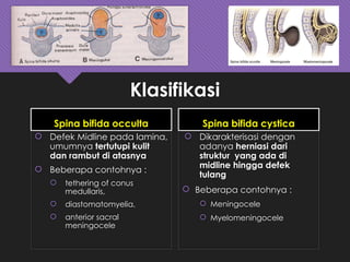 Spina bifida overview.pptx spina bifida anak | PPTX