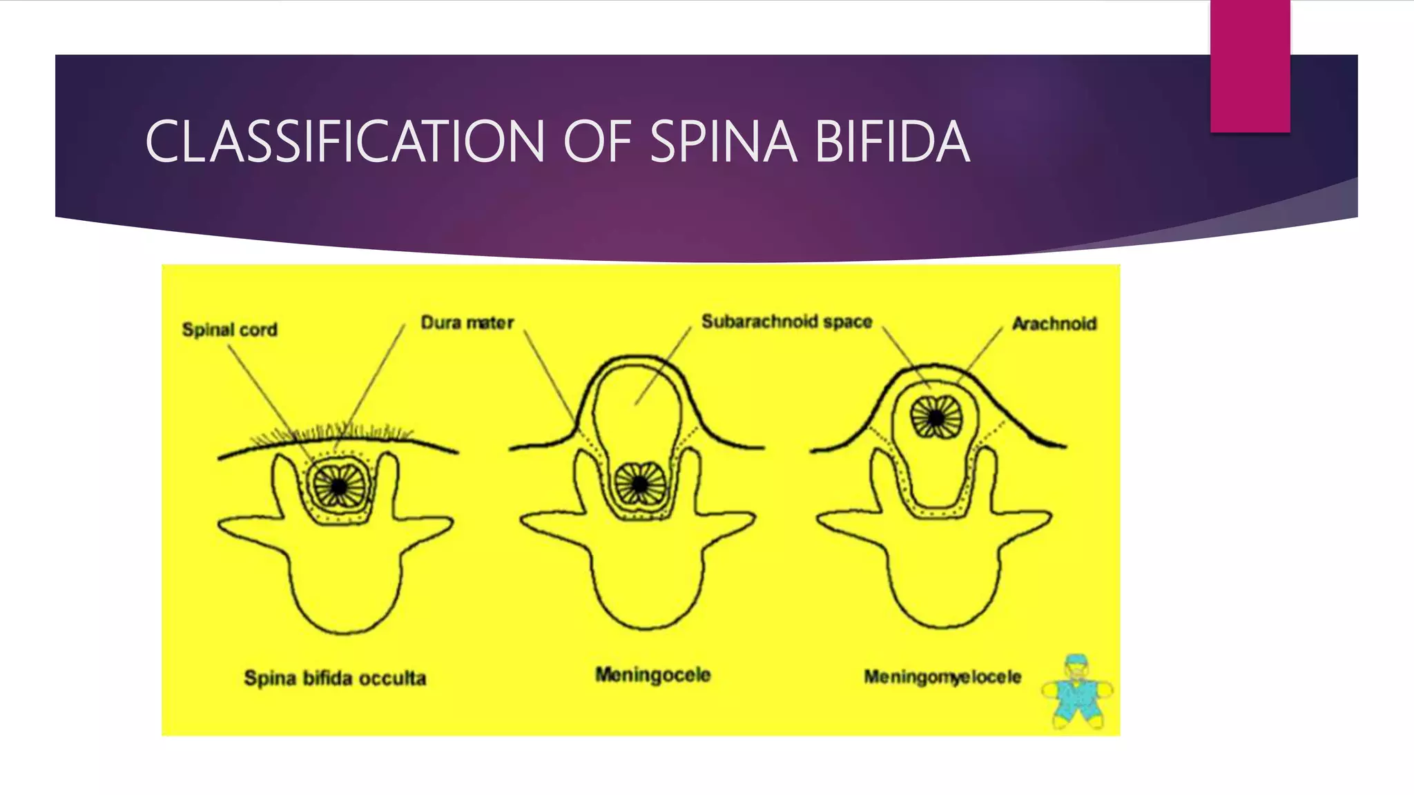 Spina bifida ppt | PPTX