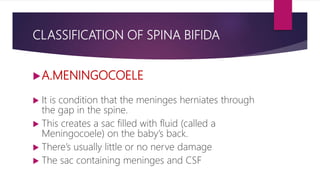 Spina bifida ppt | PPTX